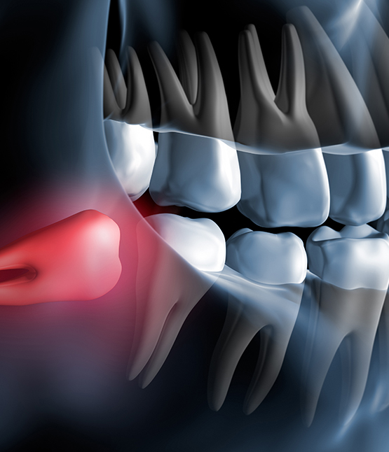 Oralna hirurgija i implantologija