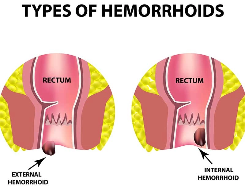 Sklerozacija hemoroida