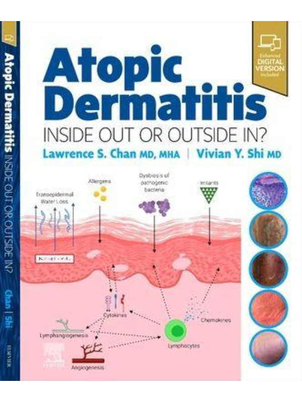 Atopic Dermatitis: Inside Out or Outside In