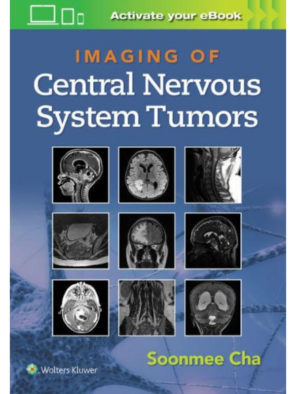 Imaging Of Cns Tumors Cb