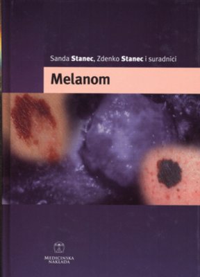 Melanom