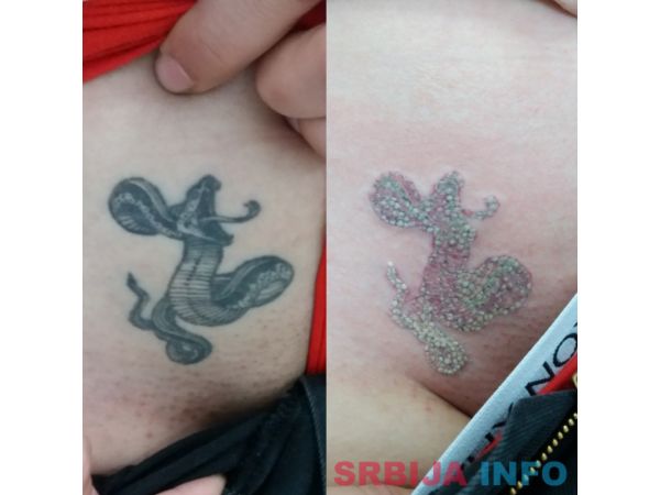 Lasersko skidanje tetovaza