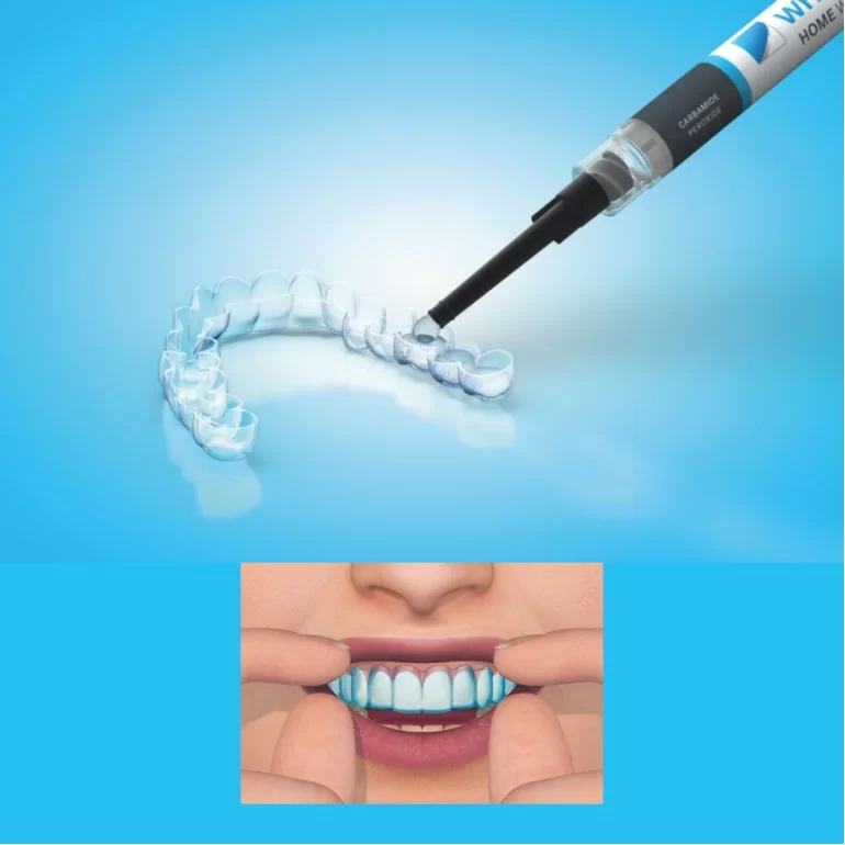 WHITE SMILE HOME WHITENING GEL KARBAMID PEROKSID ZA KUĆNO BELJENJE ZUBA