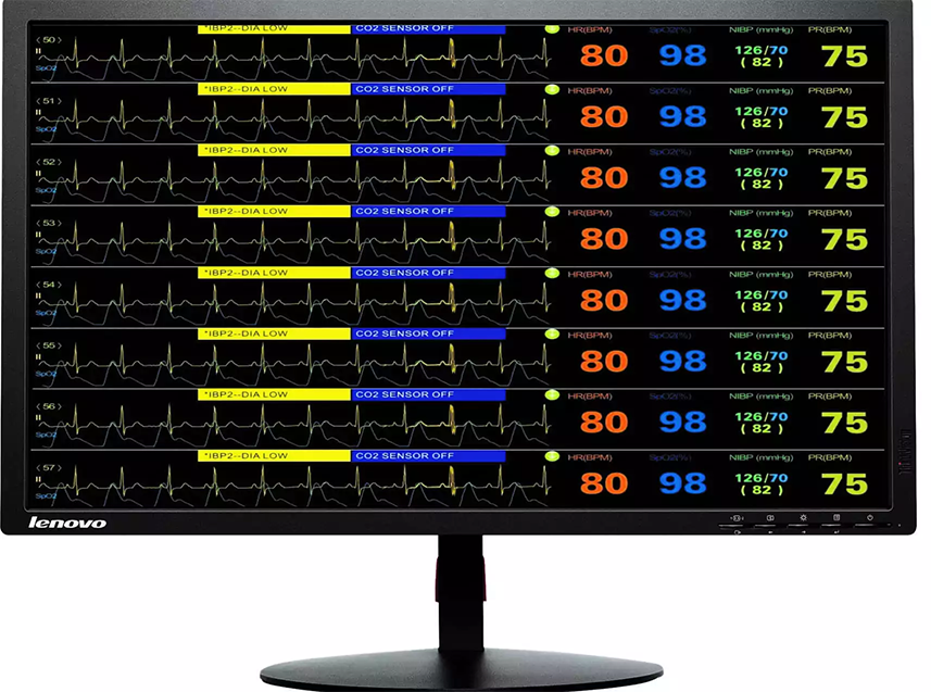 Centralni monitoring PC Macs za pacijent monitore