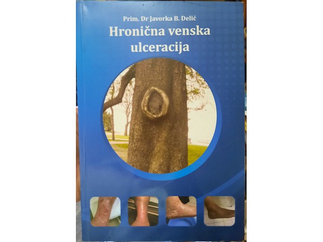 Hronična venska ulceracija