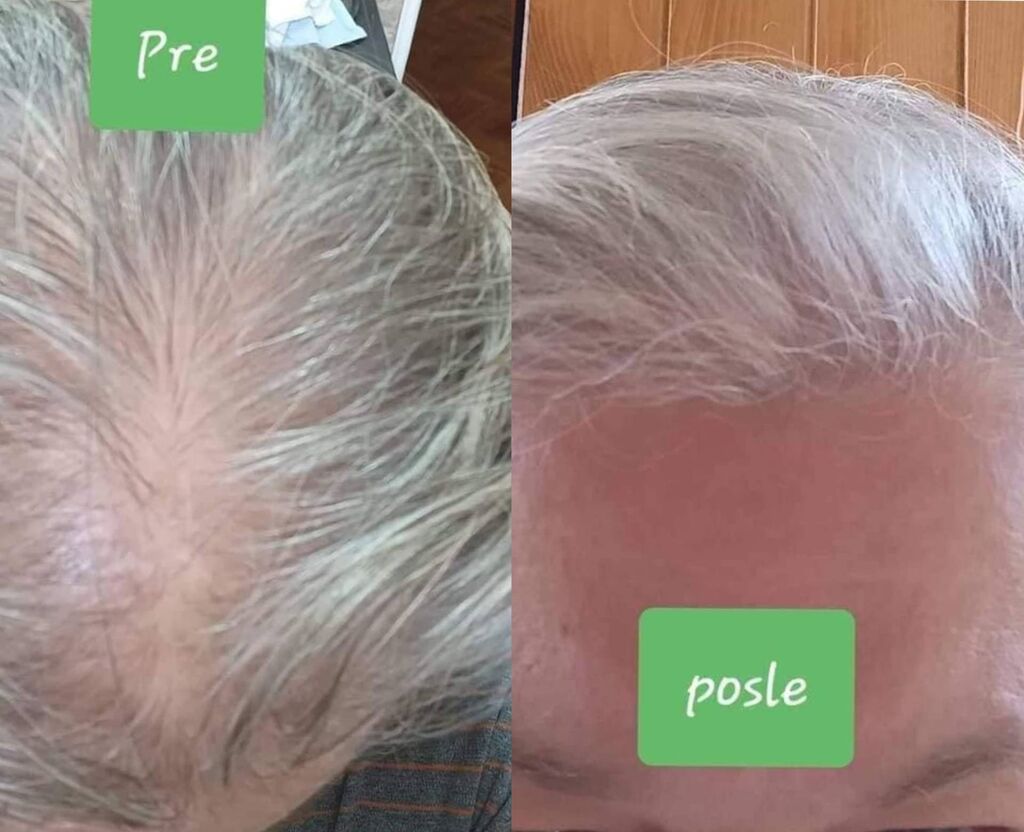       Kosalim losion za novi rast kose sa klinički dokazanim dejstvom