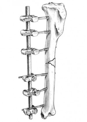 External Skeletal Fixator System - Mini