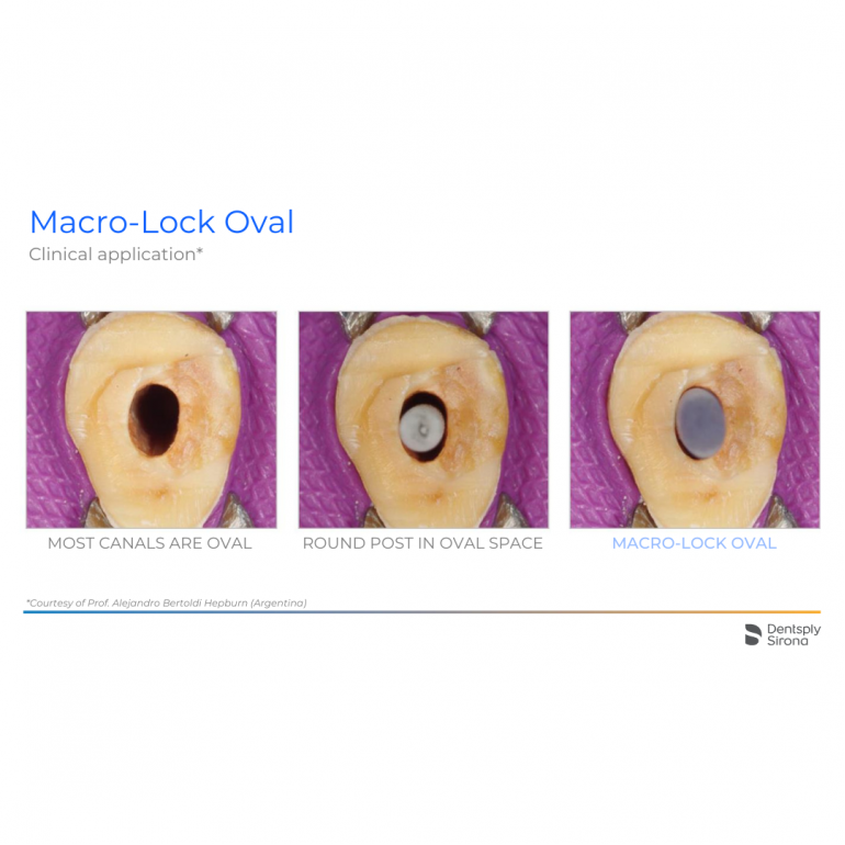 RTD MACRO-LOCK OVAL FIBER KOČIĆI