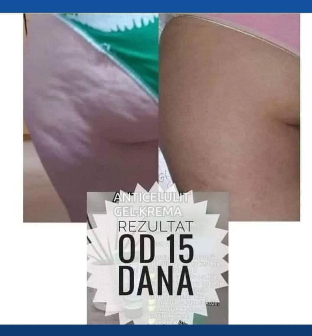 Resite se celulita za samo 15 dana