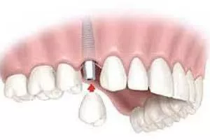 Krunice na implantima