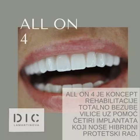 ALL ON 4 ZUBNI IMPLANTI