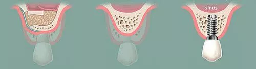 Sinus lift operacija