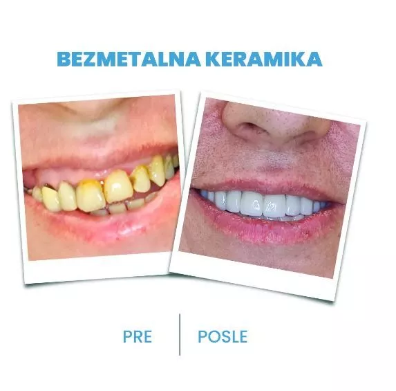 BEZMETALNA KRUNA (CIRKONIJUM)