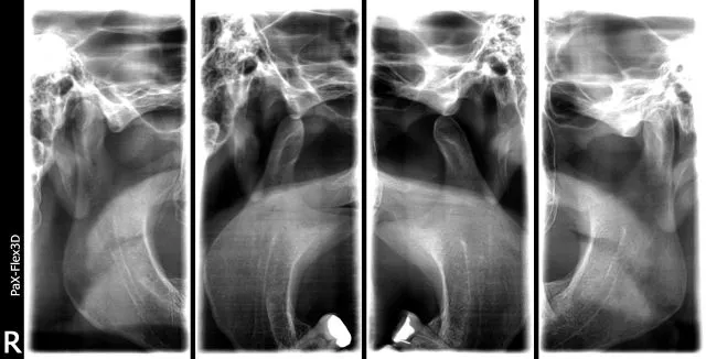 SNIMAK TEMPOROMANDIBULARNIH ZGLOBOVA