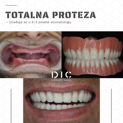 TOTALNA PROTEZA