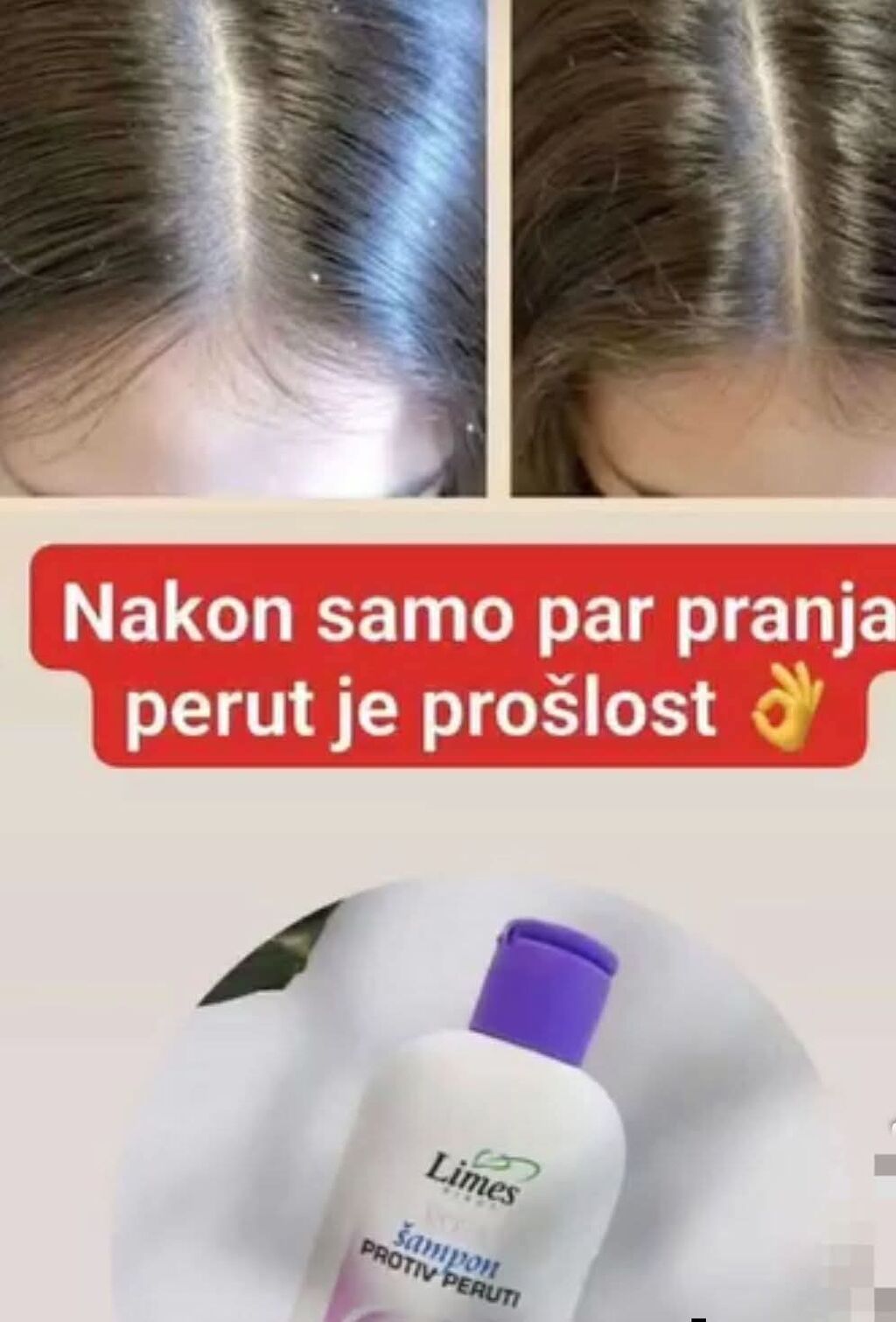 ❄️ Šampon protiv peruti – čista kosa, zdravo teme!    Zaboravi na