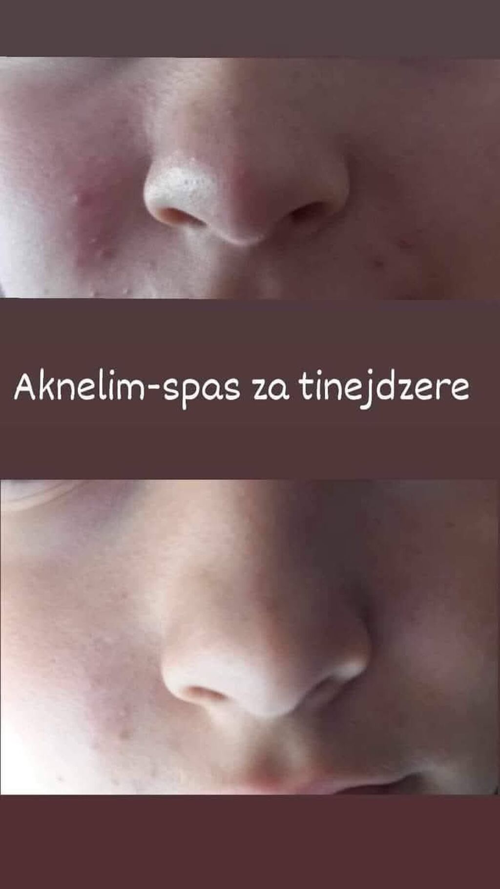 Aknelim gel 30ml – 100% delotvoran saveznik protiv akni Iskoristite