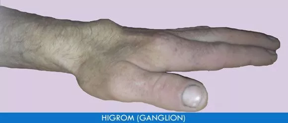 HIGROM (GANGLION)
