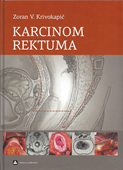 Карцином ректума