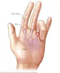 TENDOVAGINITIS (TRIGER FINGER)