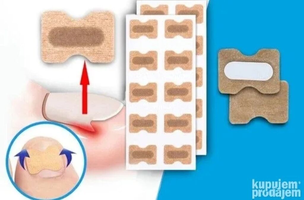 Flasteri za urasle nokte – korektivne trakice za podizanje ivica nokta