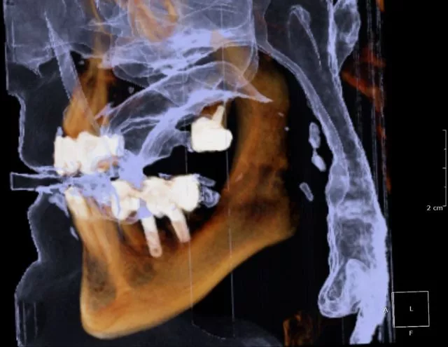 3D SNIMAK VAZDUŠNIH PUTEVA SA KOŠTANIM PROFILOM