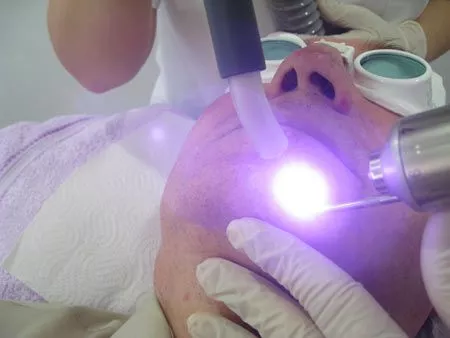 LASERSKO LEČENJE ROZACEE